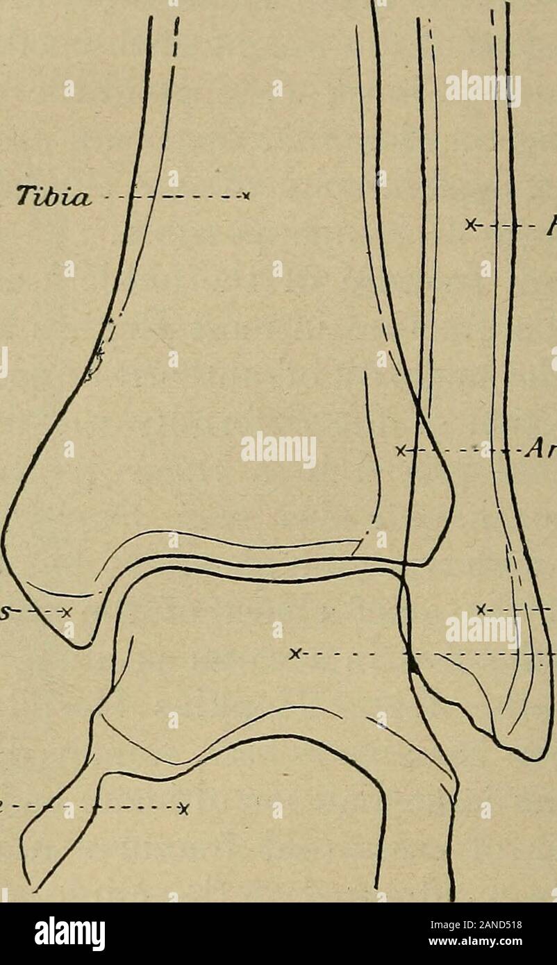 Atlas and epitome of traumatic fractures and dislocations . )eration ...
