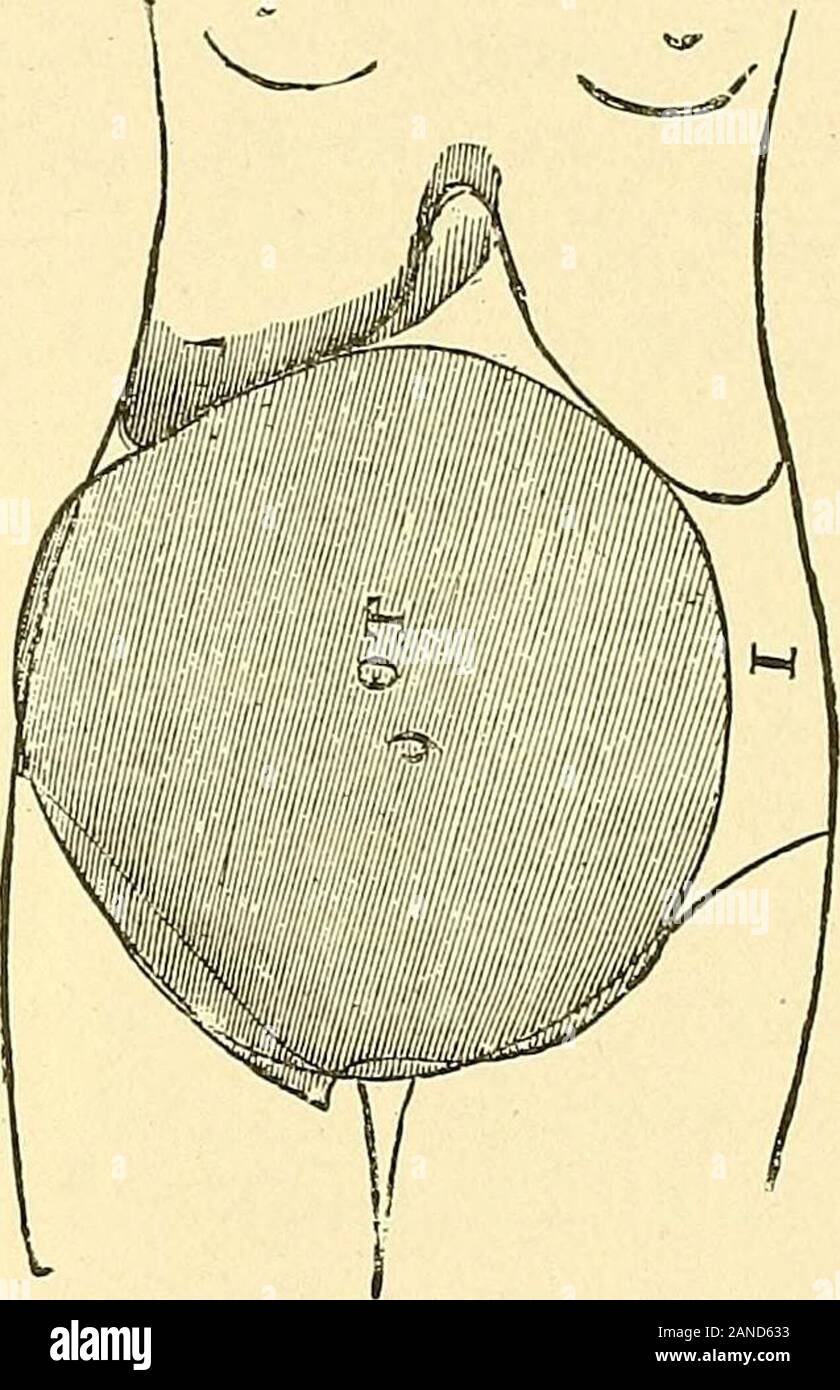 Treatise on gynaecology : medical and surgical . Fig. 43. Outline op ...