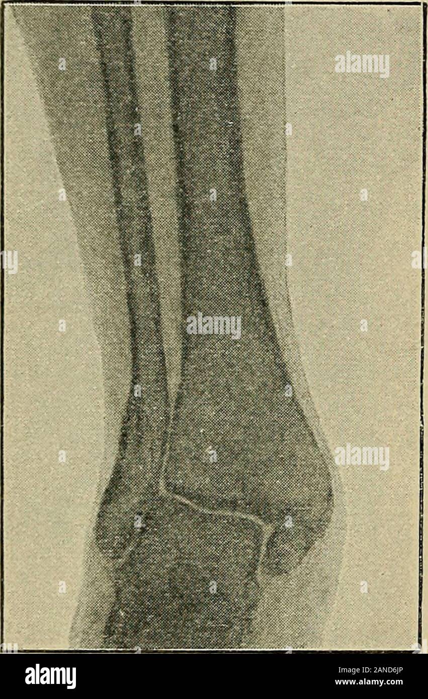 Displaced fracture hi-res stock photography and images - Alamy