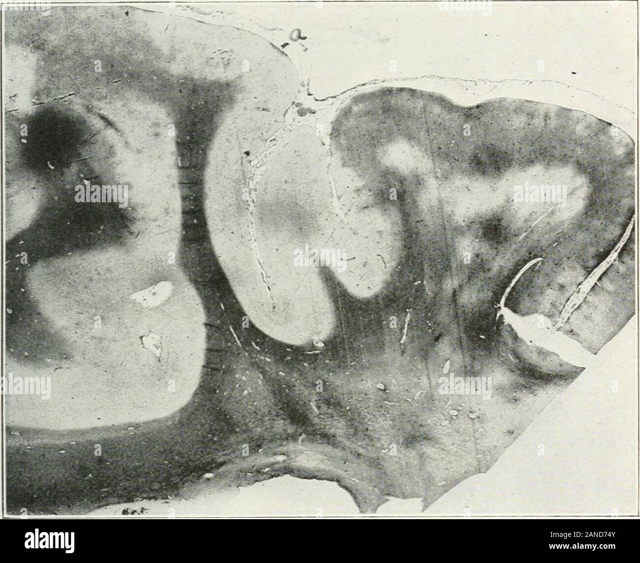 AMAarchives of neurology & psychiatry . e matter; b, multilocular cyst ...