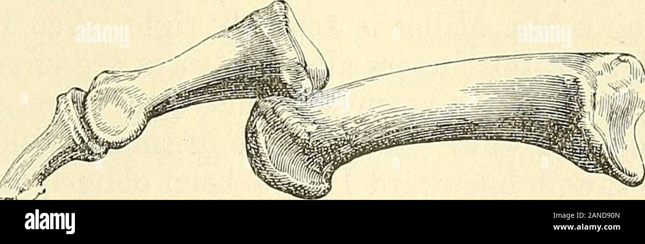 Thumb dislocation hi-res stock photography and images - Alamy