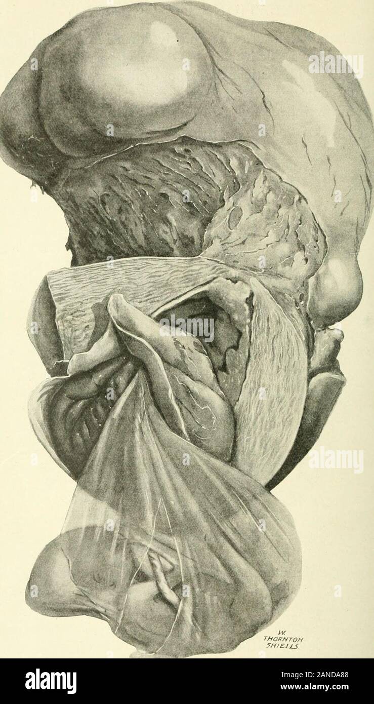 Fibroids and allied tumours (myoma and adenomyoma) : their pathology ...