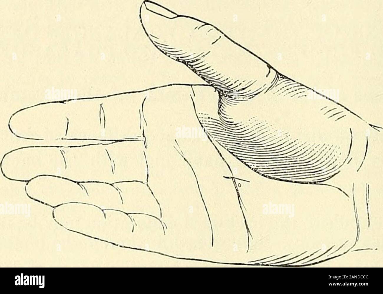 Thumb dislocation hi-res stock photography and images - Alamy