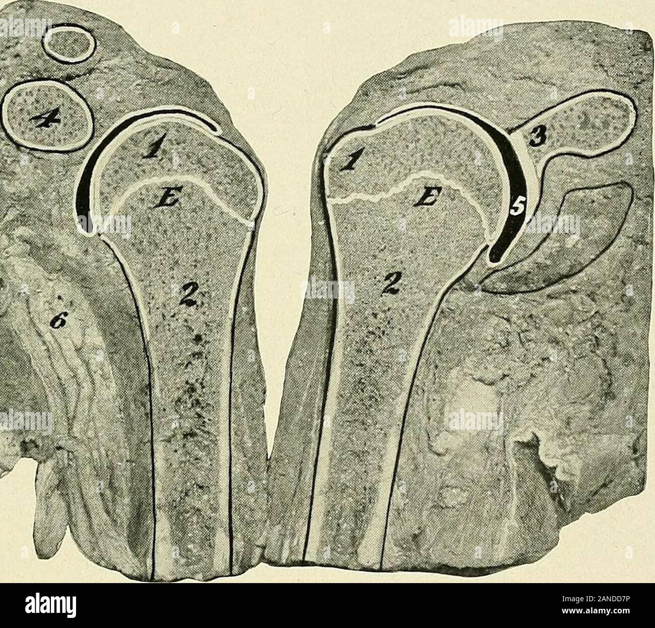 Cephalic vein hi-res stock photography and images - Alamy