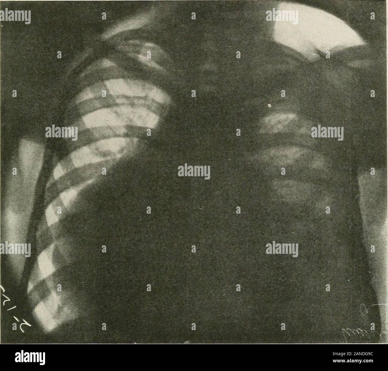 Fibrinous Pericarditis