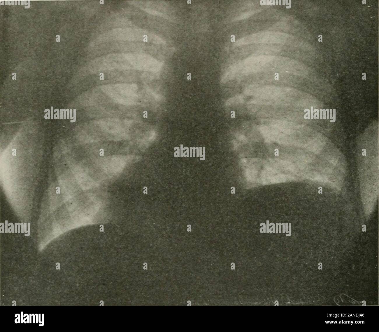 Pleura space hi-res stock photography and images - Alamy