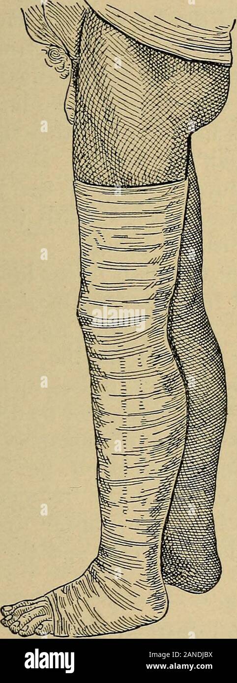 Rigid splints hi-res stock photography and images - Alamy