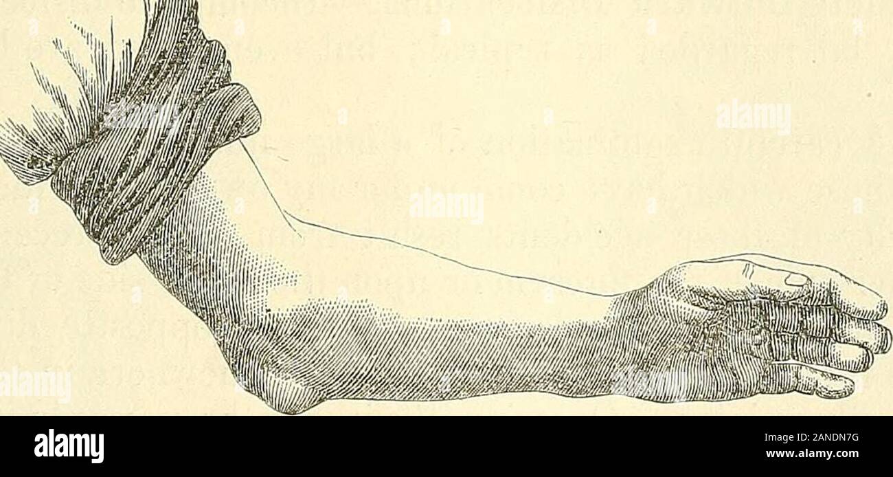 Olecranon process hi-res stock photography and images - Alamy