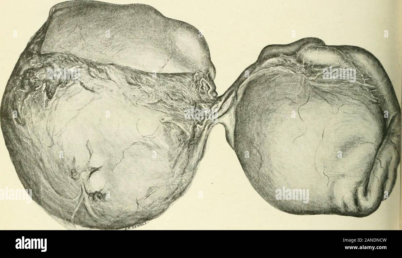 Fundus of uterus hi-res stock photography and images - Alamy