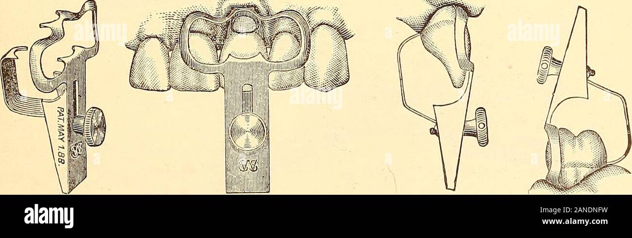 Principles and practice of operative dentistry . The Ottolengui clamp ...