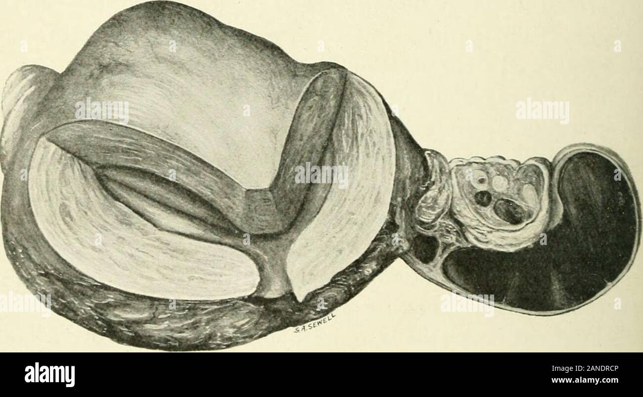 Fibroids and allied tumours (myoma and adenomyoma) : their pathology ...