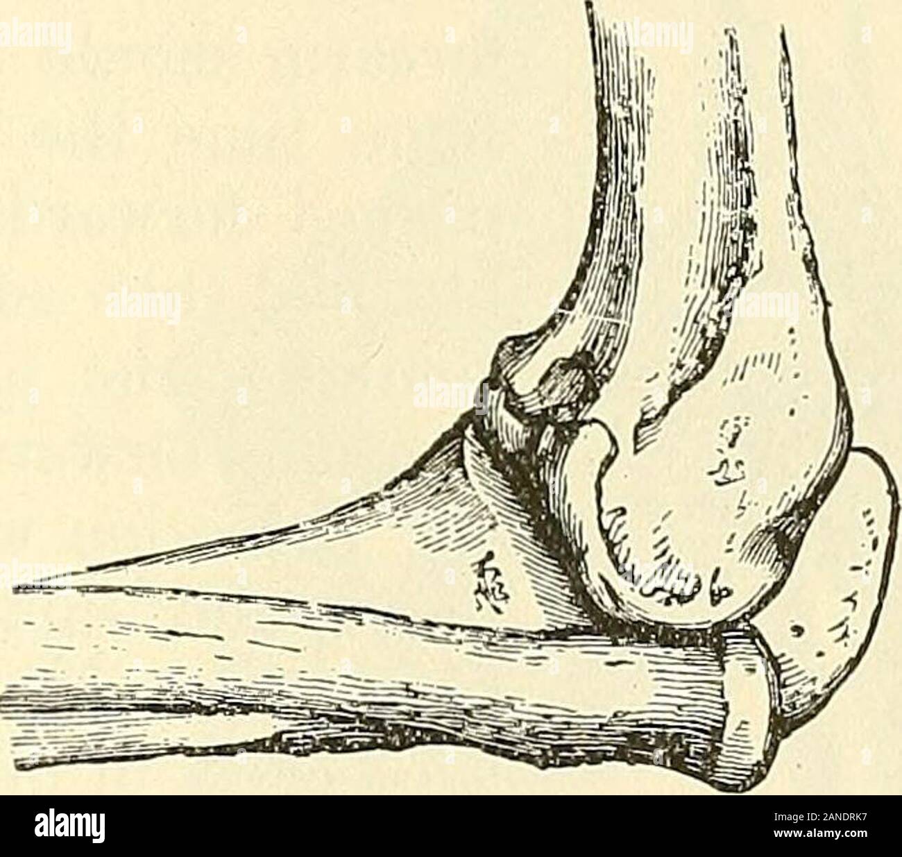 Radial Head Dislocation High Resolution Stock Photography and Images ...