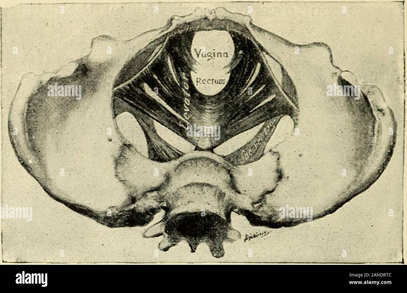 A textbook of obstetrics . Fig- 9-—The pelvic canal encroached upon by ...