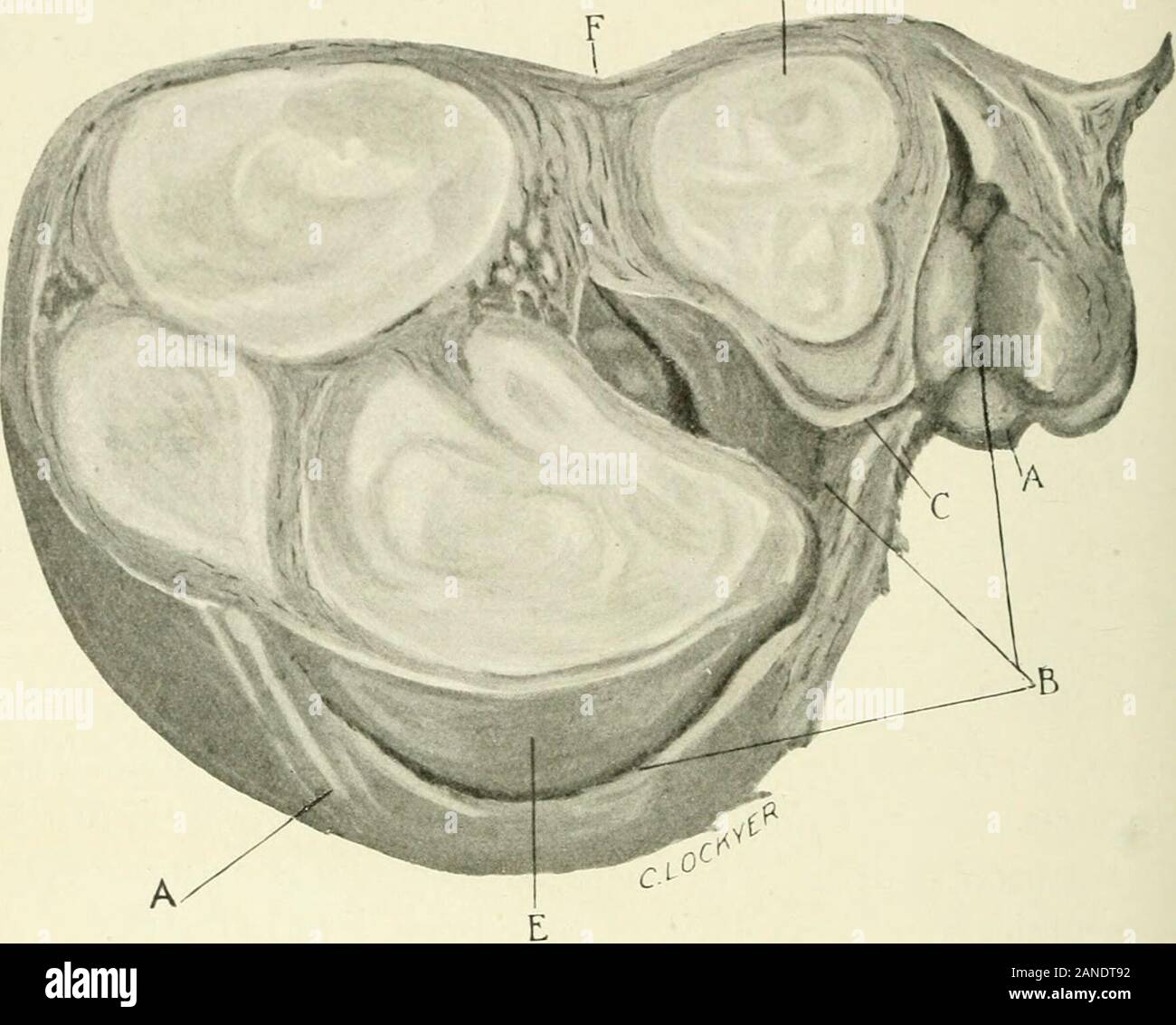 Fibroids and allied tumours (myoma and adenomyoma) : their pathology ...