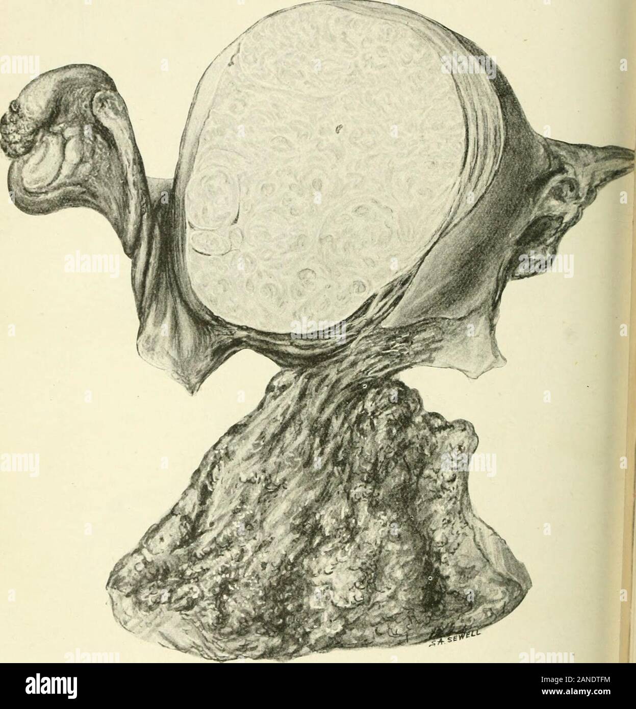 Fibroids and allied tumours (myoma and adenomyoma) : their pathology ...