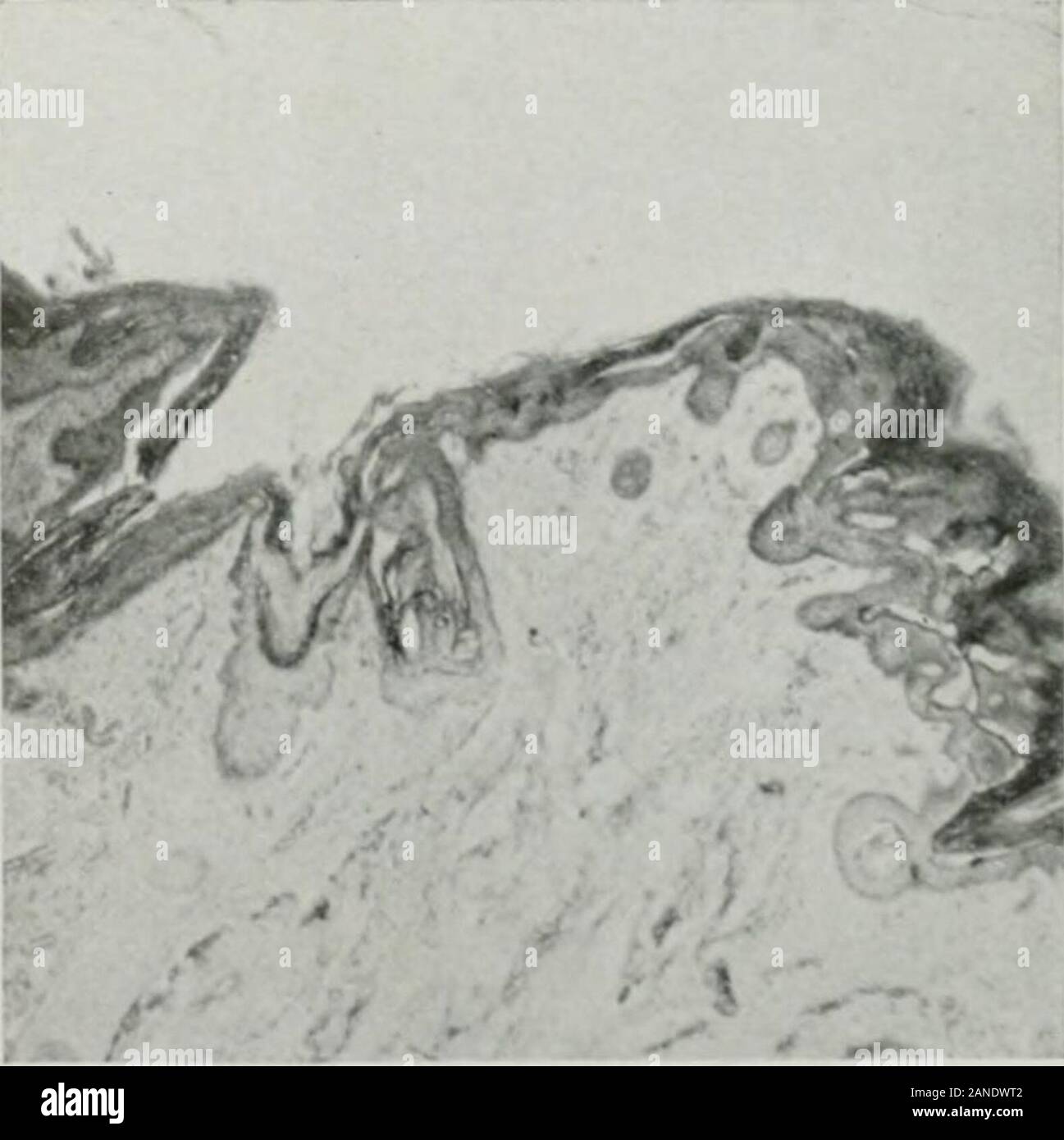 Hypertrophy of heart cells hi-res stock photography and images - Alamy