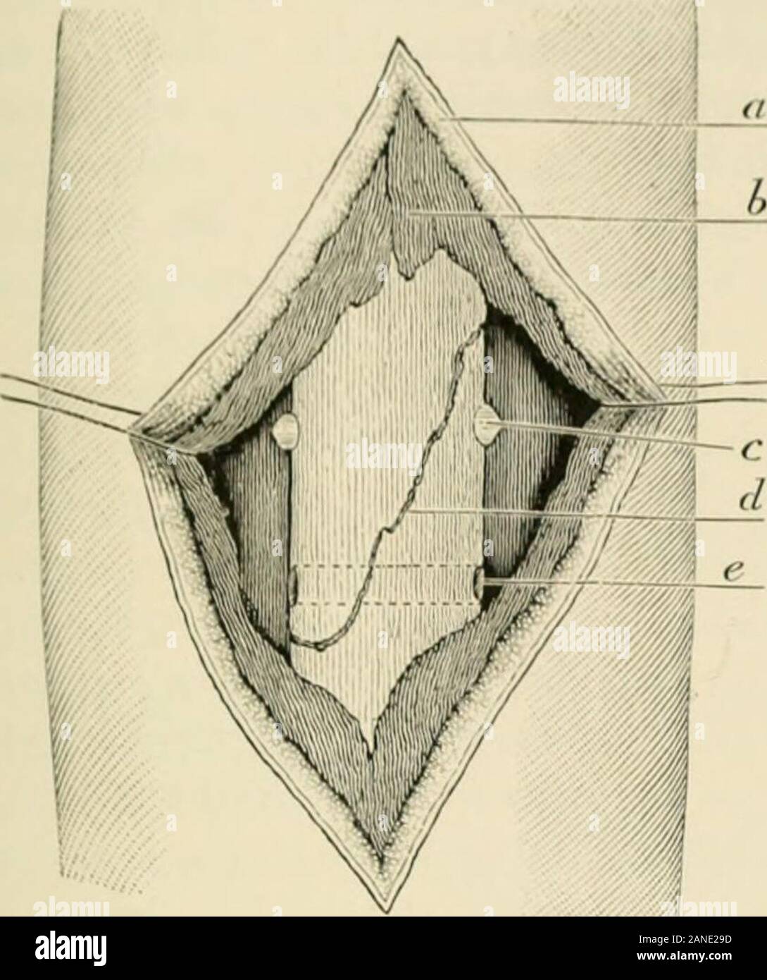 Operative surgery . Pig. 1543.—Frame ligature of oblique fracture ...