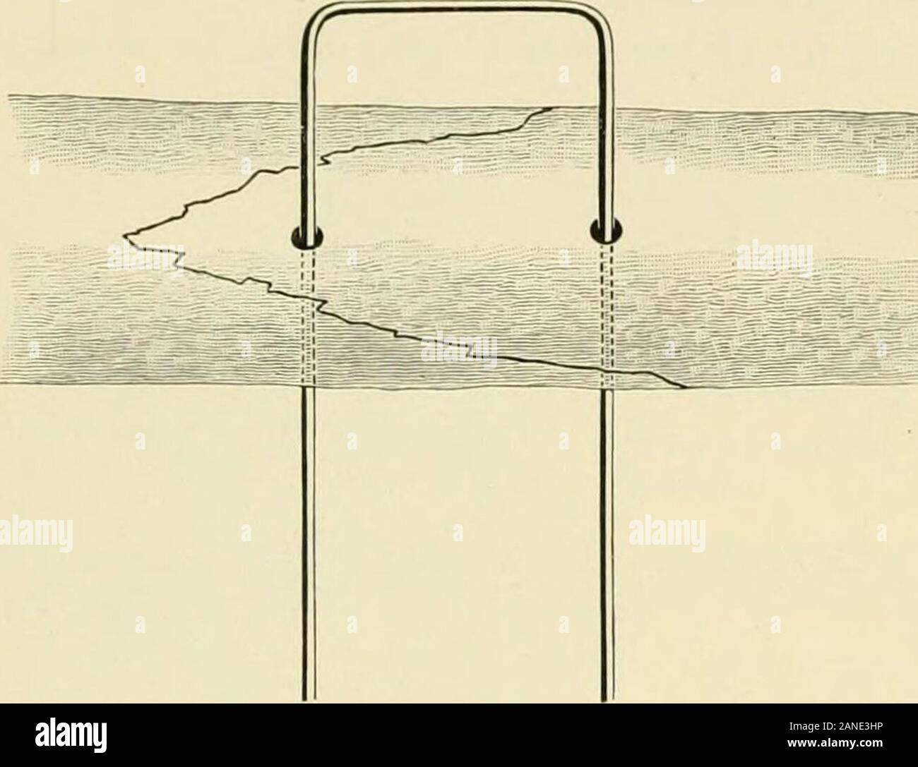 Oblique bone fracture hi-res stock photography and images - Alamy