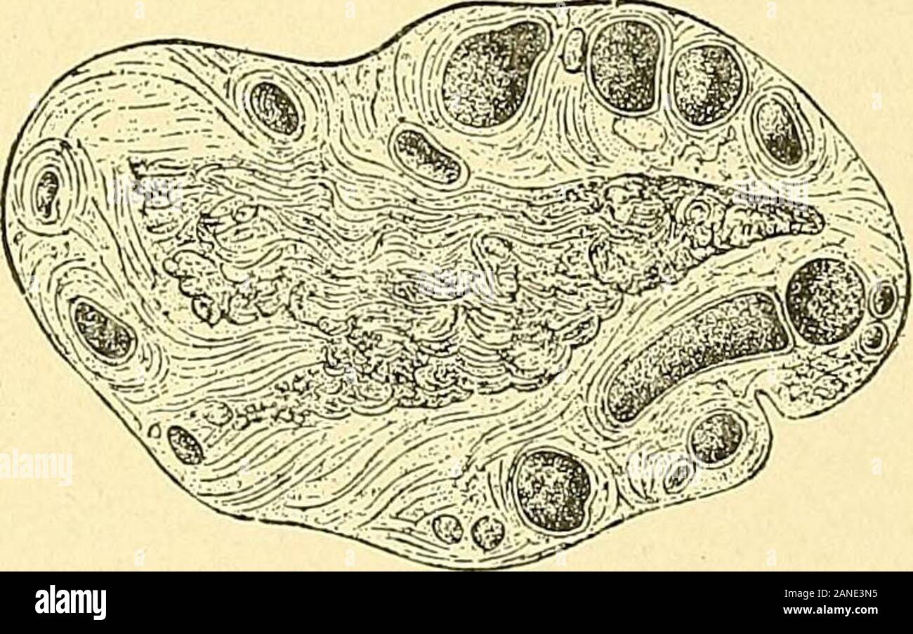 Acute salpingitis hi-res stock photography and images - Alamy