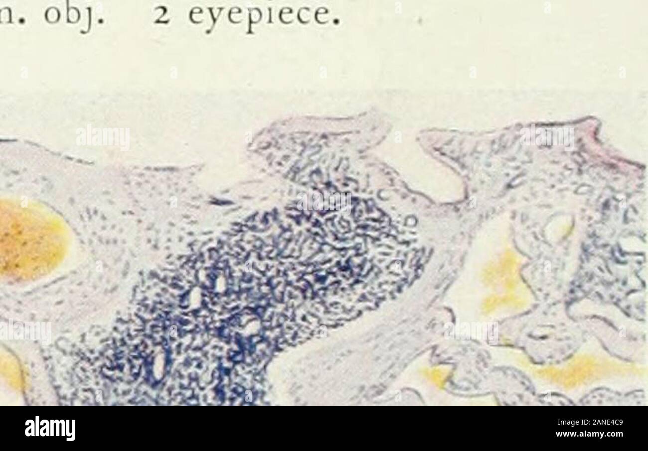 Angiomatous hi-res stock photography and images - Alamy