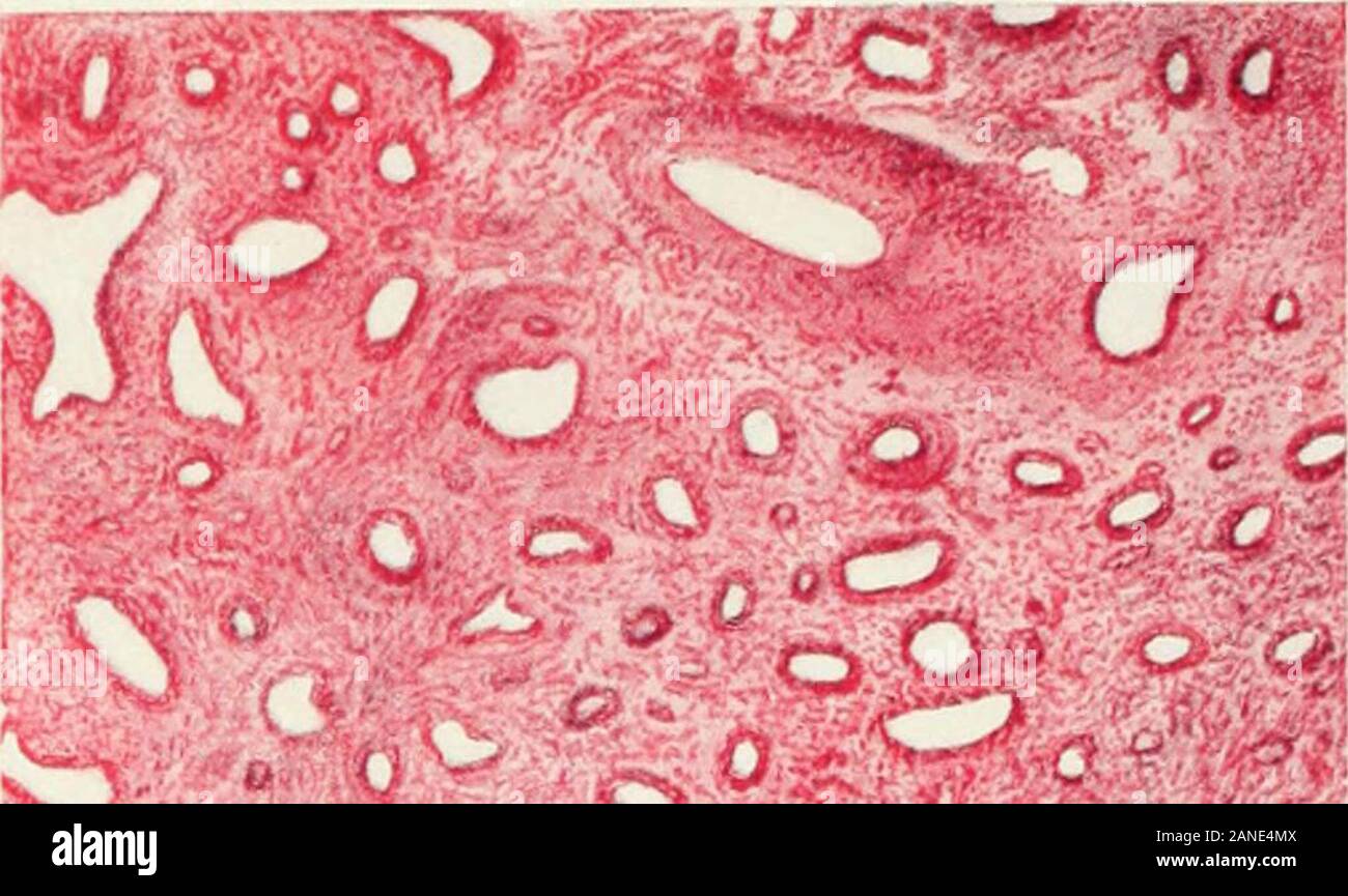 Fibroids and allied tumours (myoma and adenomyoma) : their pathology ...