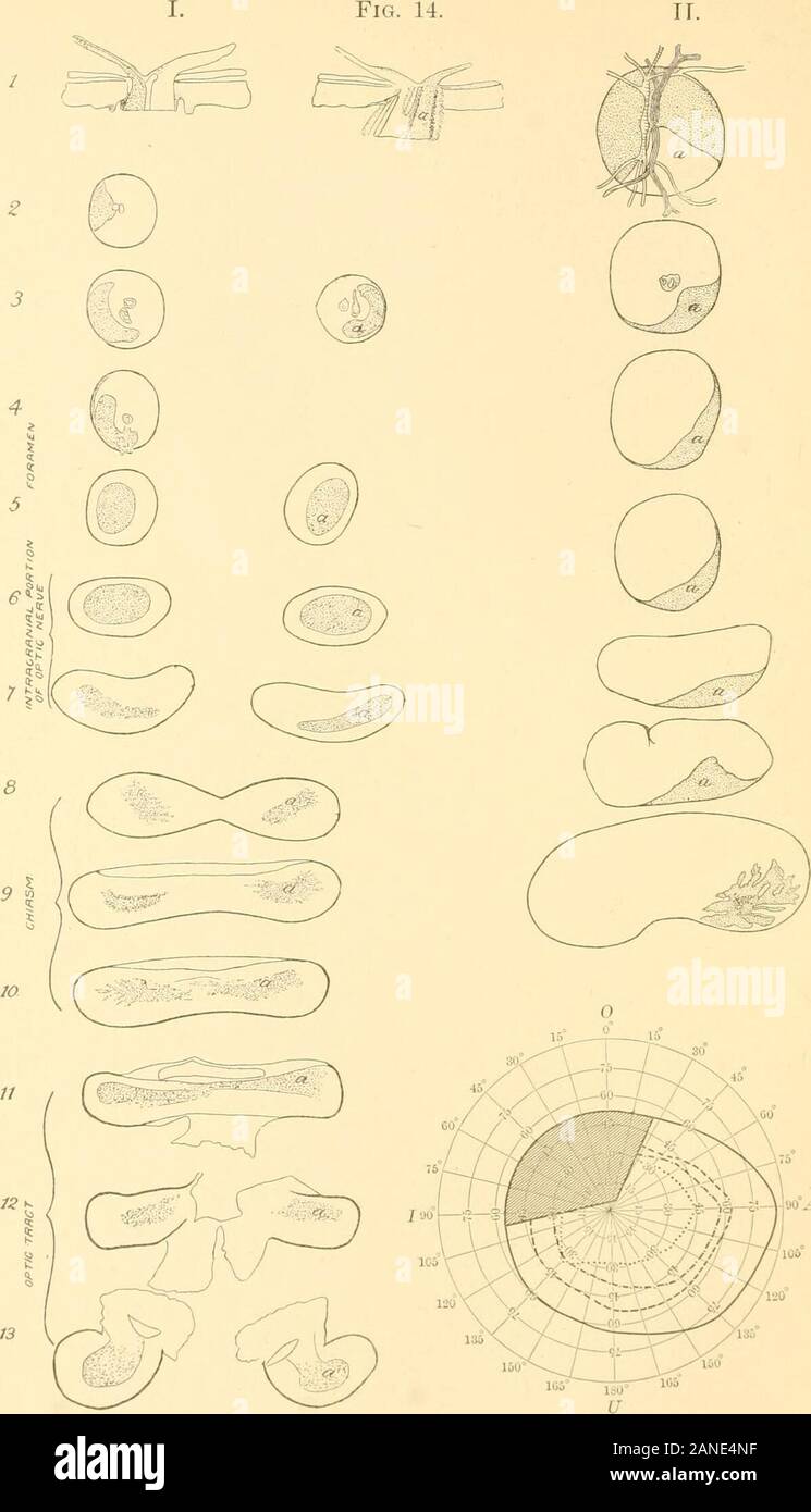 Scotoma hi-res stock photography and images - Alamy