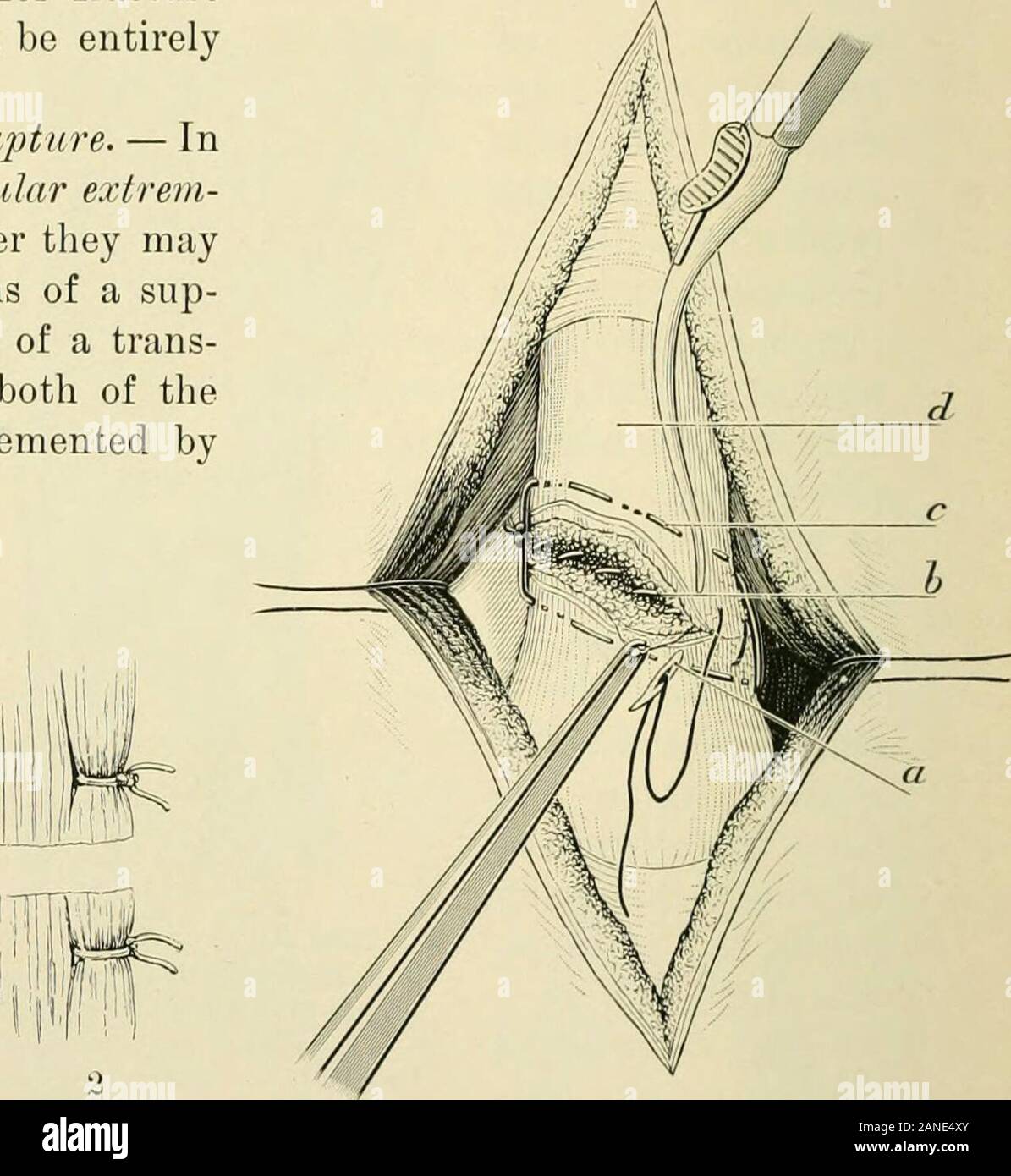 Ruptured extensor tendon hi-res stock photography and images - Alamy