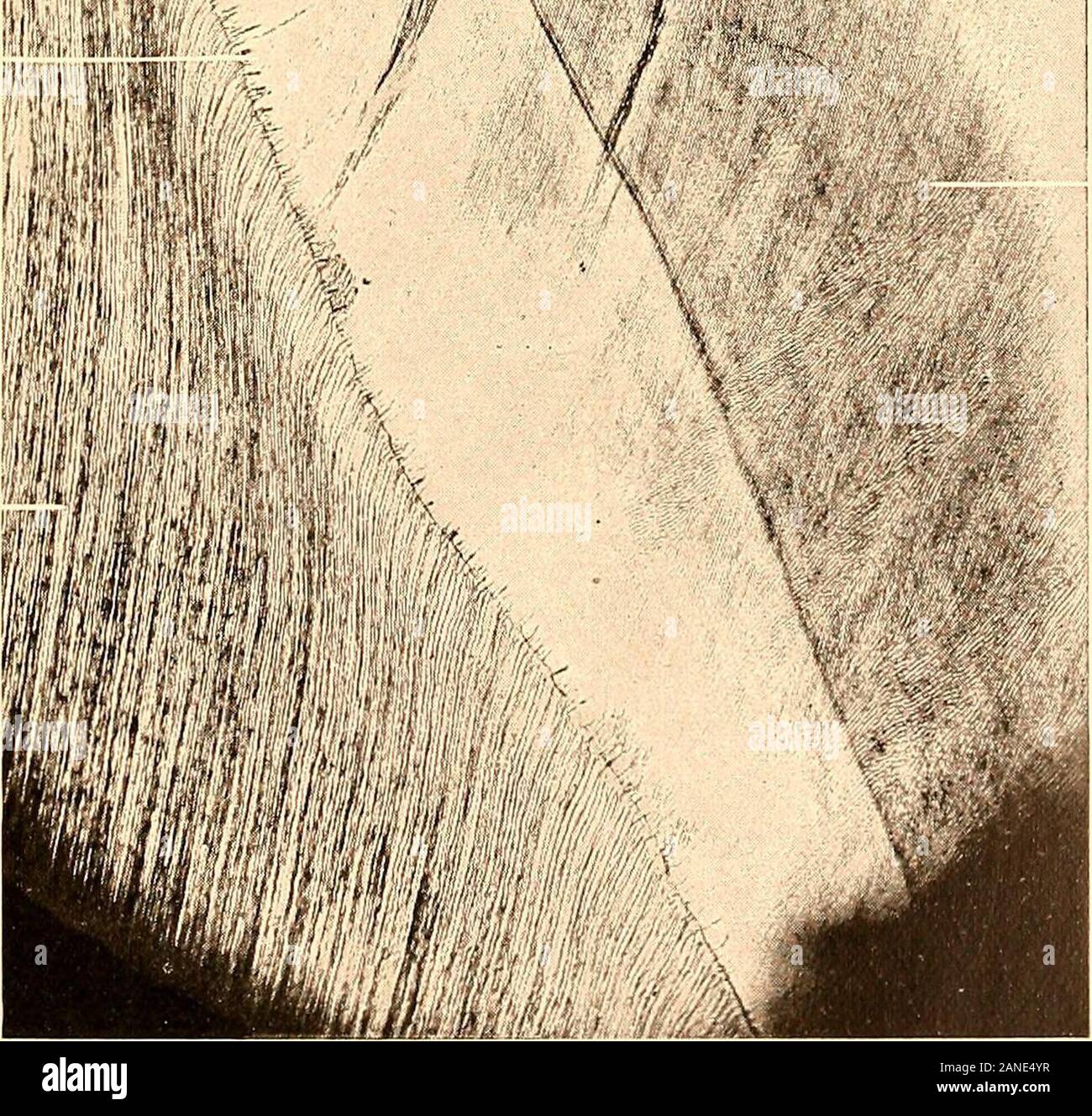 Cause of dental caries hi-res stock photography and images - Alamy