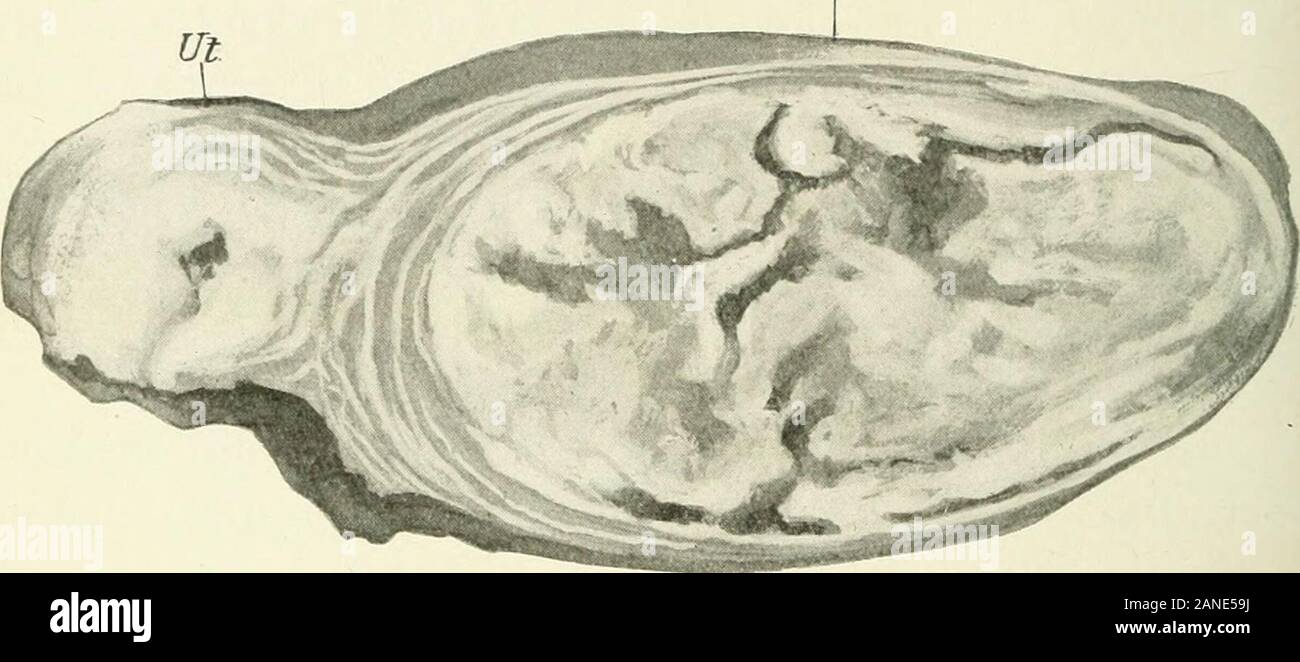 Myomas hi-res stock photography and images - Alamy