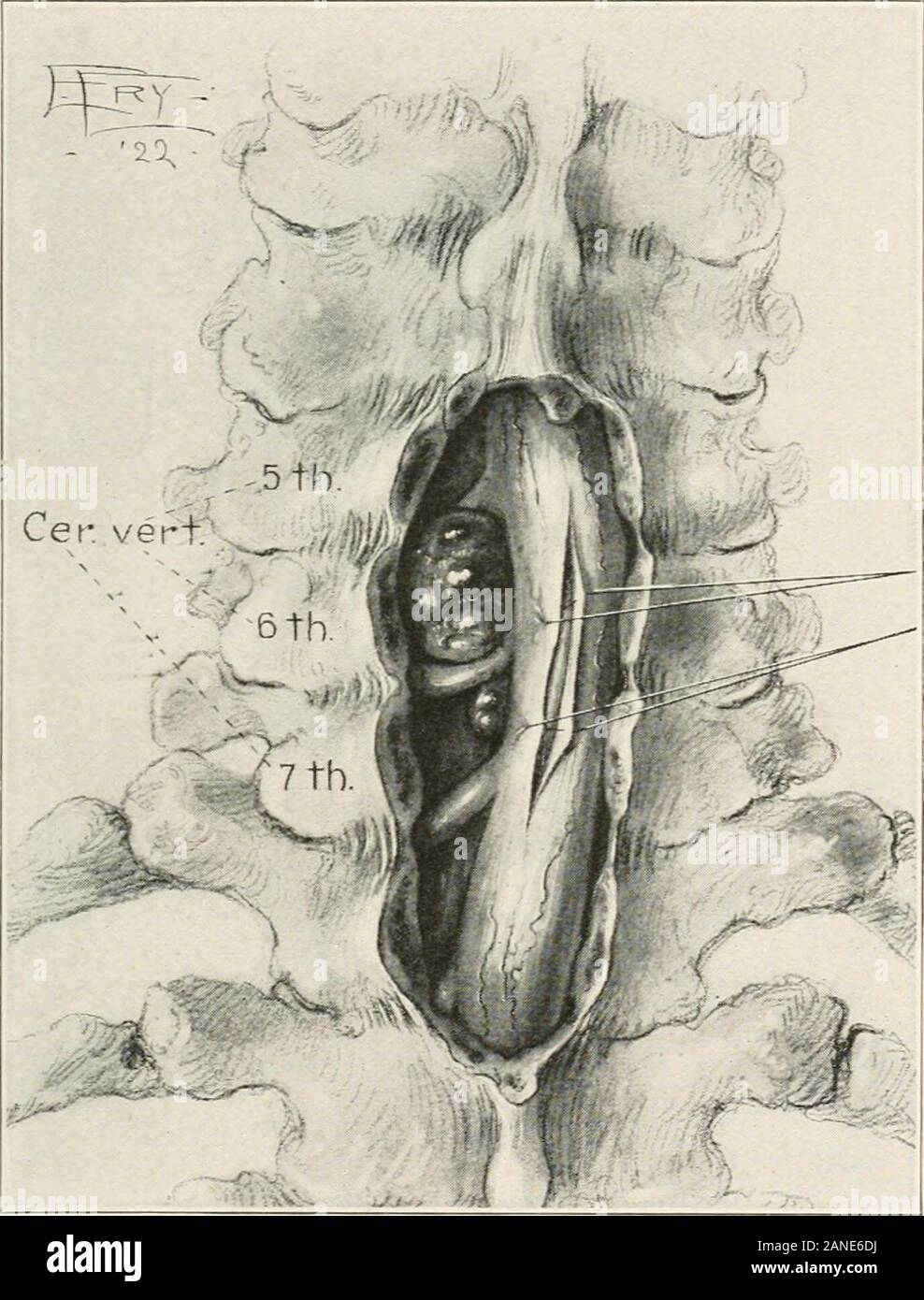 Intramedullary hi-res stock photography and images - Alamy