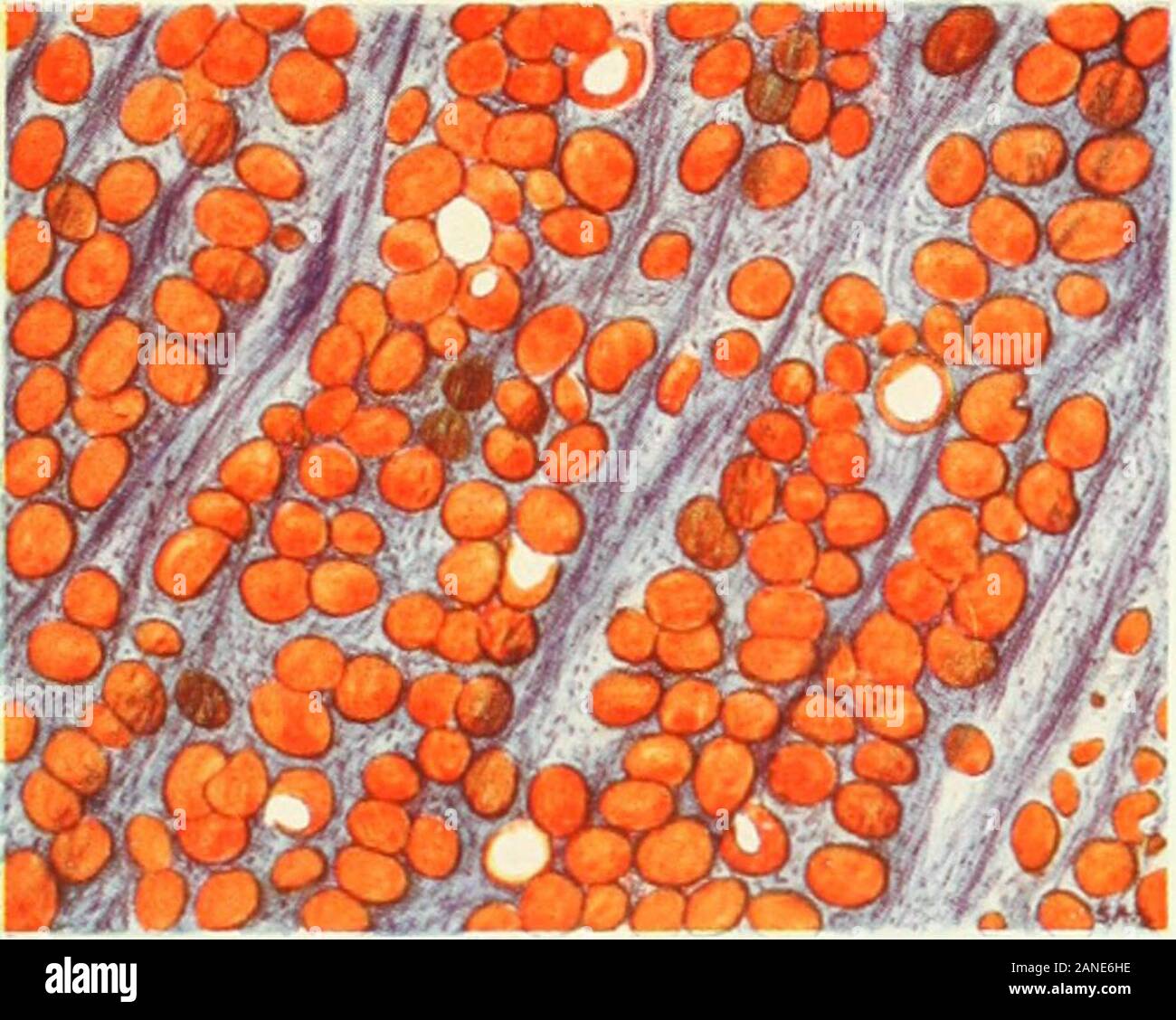 Myomas hi-res stock photography and images - Alamy