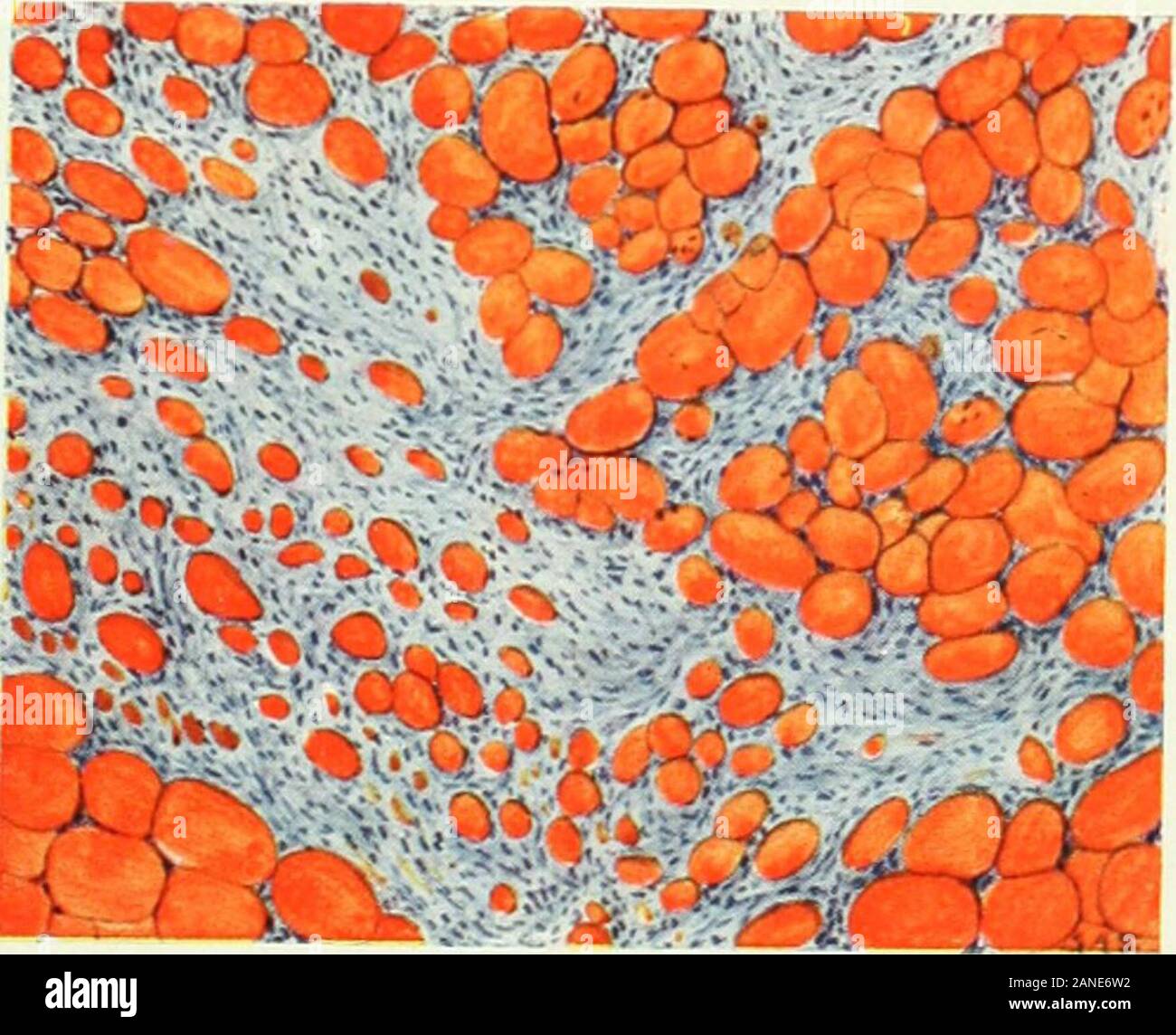 Fibroids and allied tumours (myoma and adenomyoma) : their pathology, clinical features and ...
