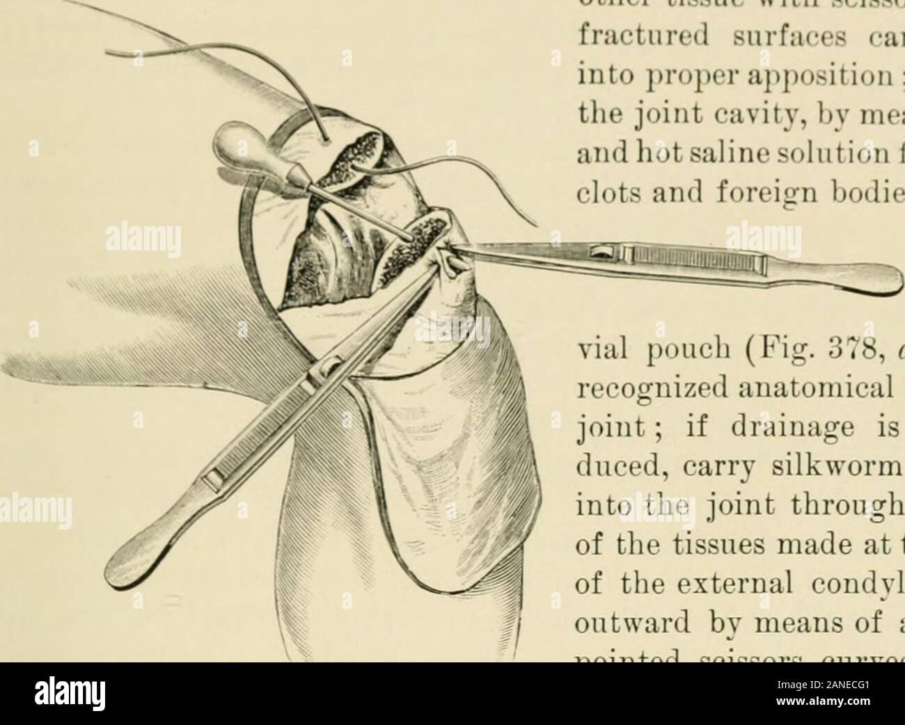 Operative surgery . fragments with a bone scooj), and intervening ...