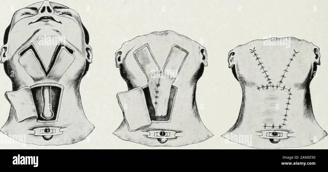 Laryngectomy tube hi-res stock photography and images - Alamy