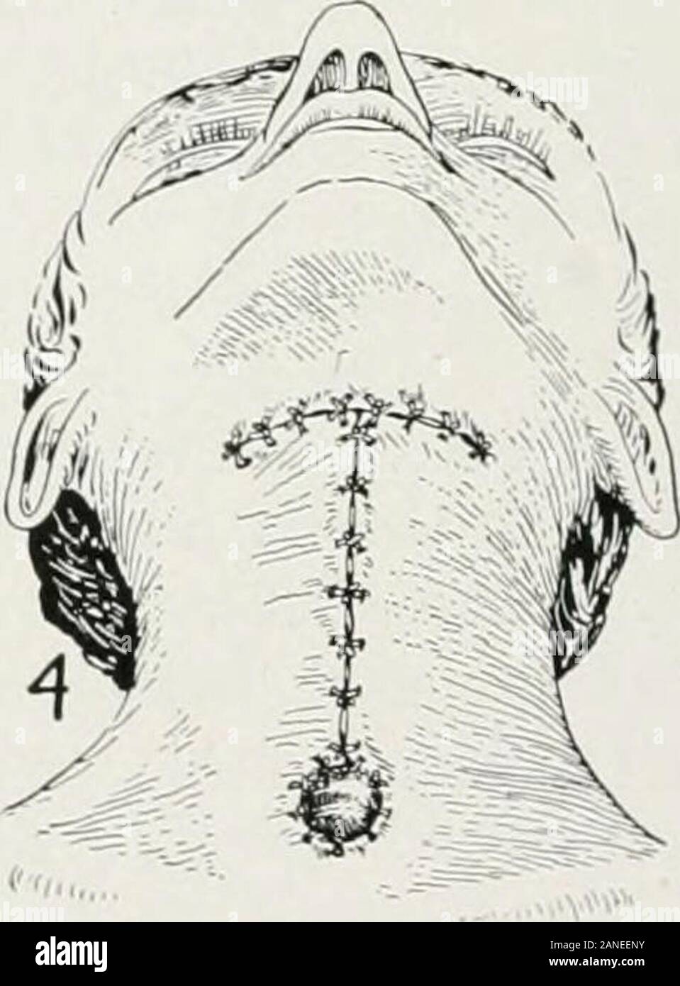Peroral endoscopy and laryngeal surgery . Fig. 489.—Schematic ...