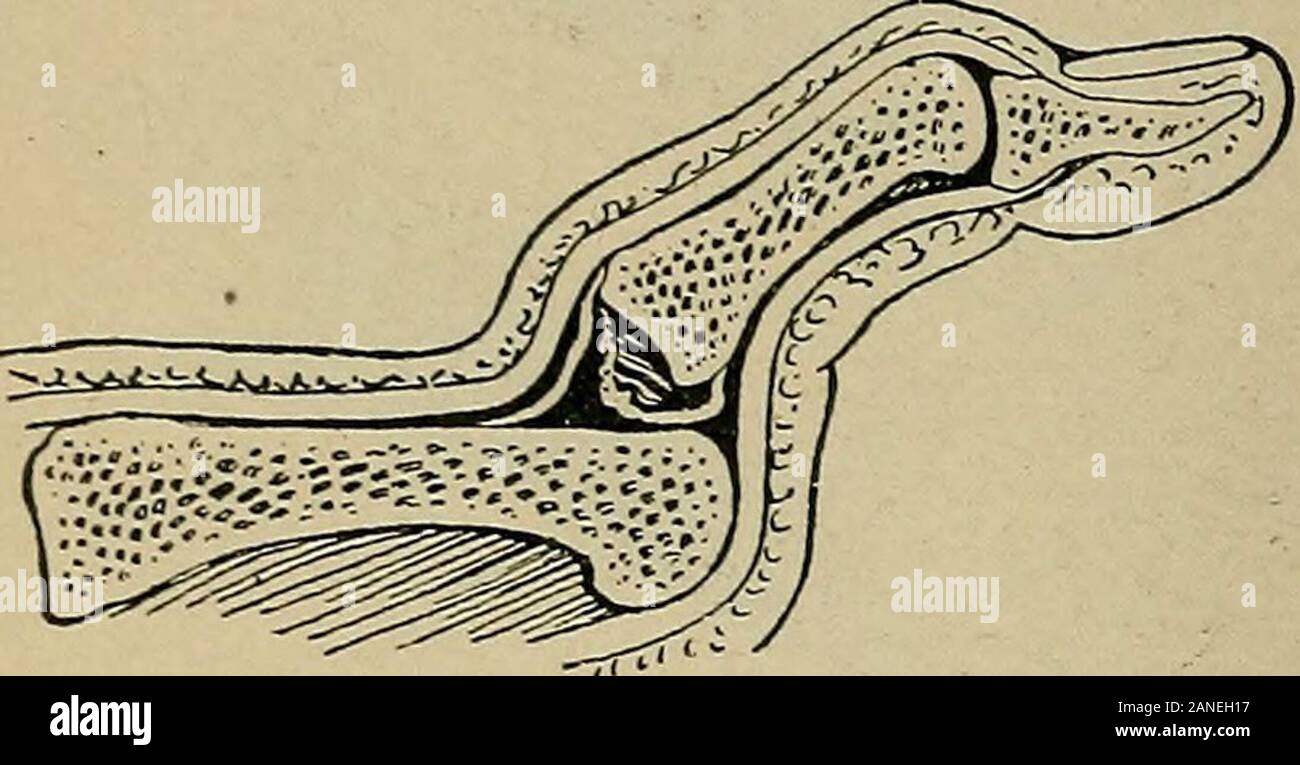 Atlas and epitome of traumatic fractures and dislocations . Fig. 110 ...