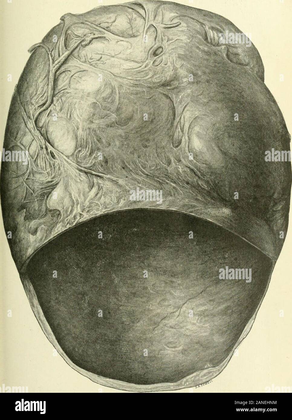 Intramural fibroids hi-res stock photography and images - Alamy