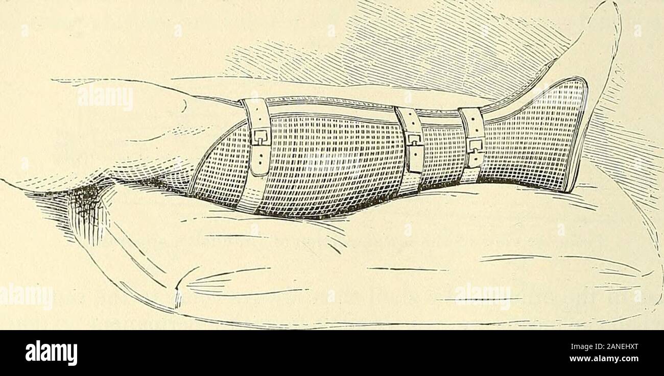 Tibia splint hi-res stock photography and images - Alamy