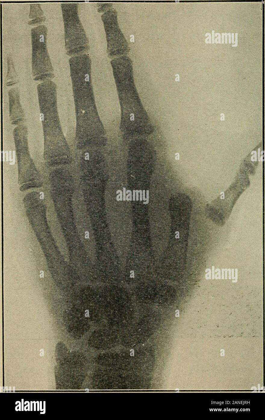 Atlas and epitome of traumatic fractures and dislocations . l padded ...