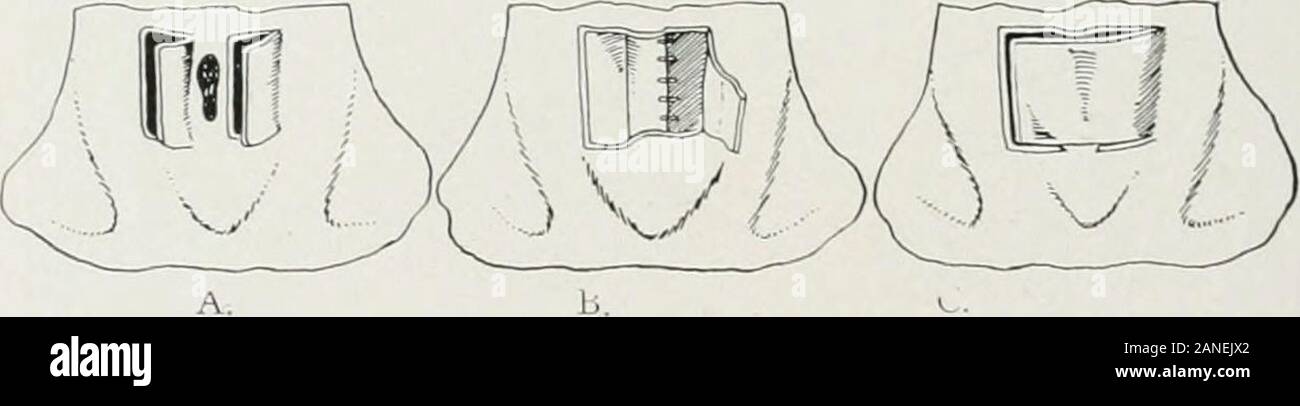 Peroral endoscopy and laryngeal surgery . Fig. 479.—Schema of the ...