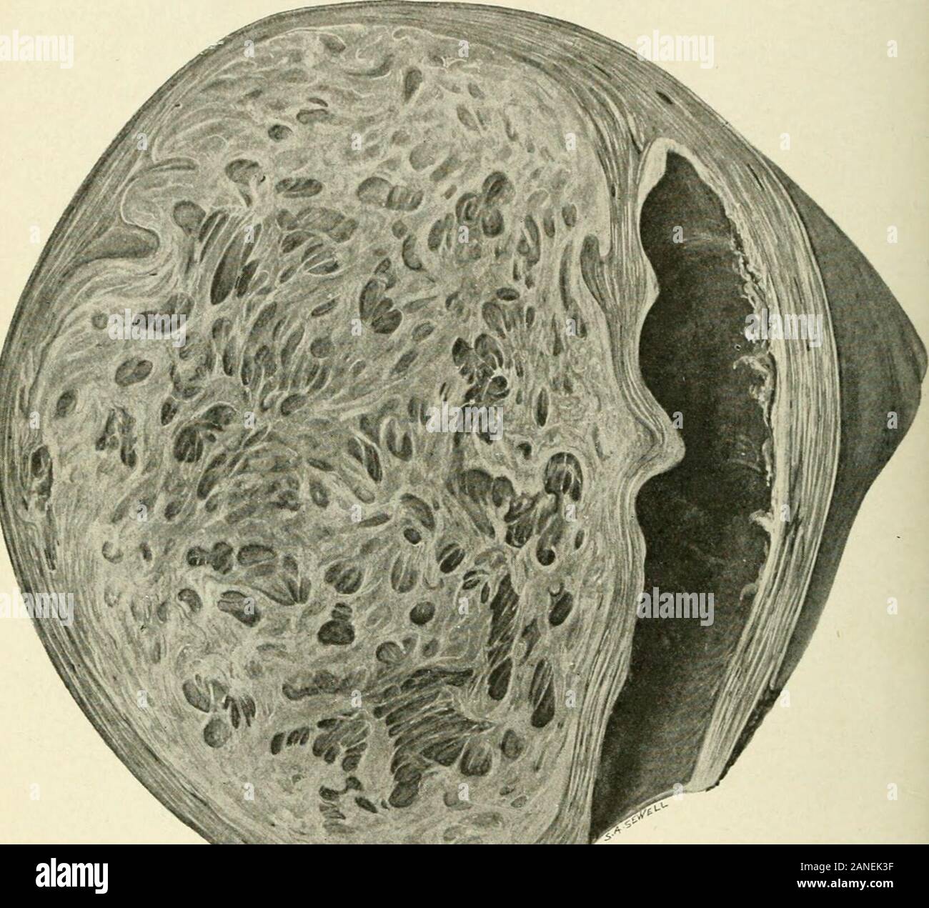 Fibroids and allied tumours (myoma and adenomyoma) : their pathology ...