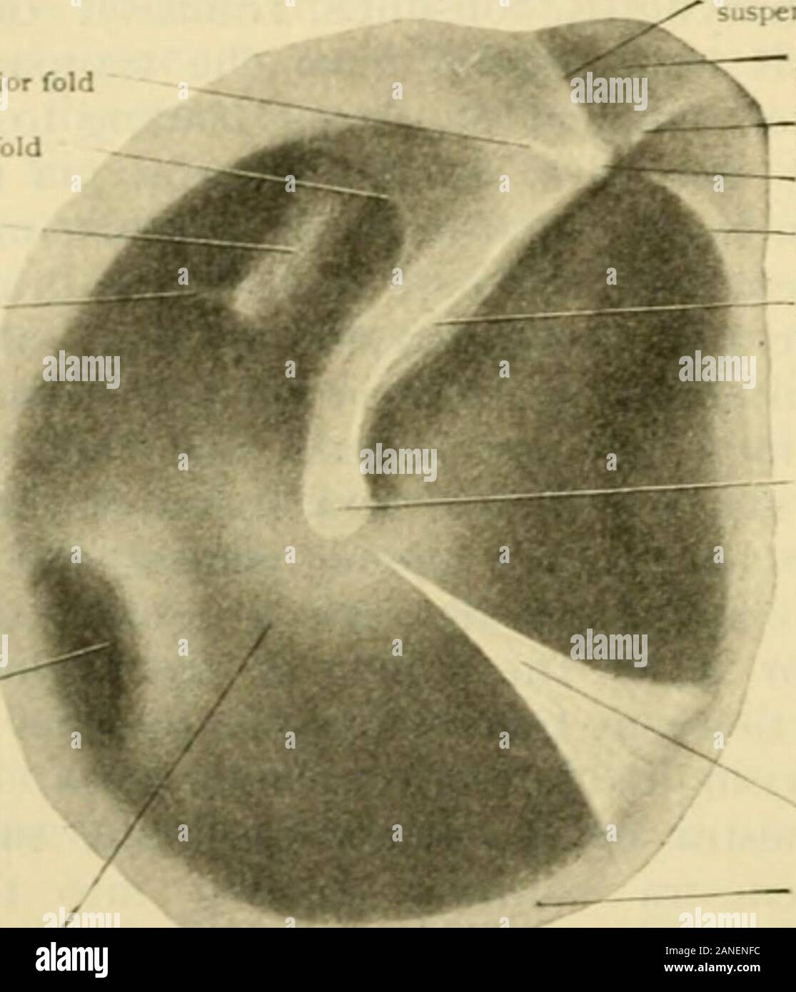 Paracentesis Ear