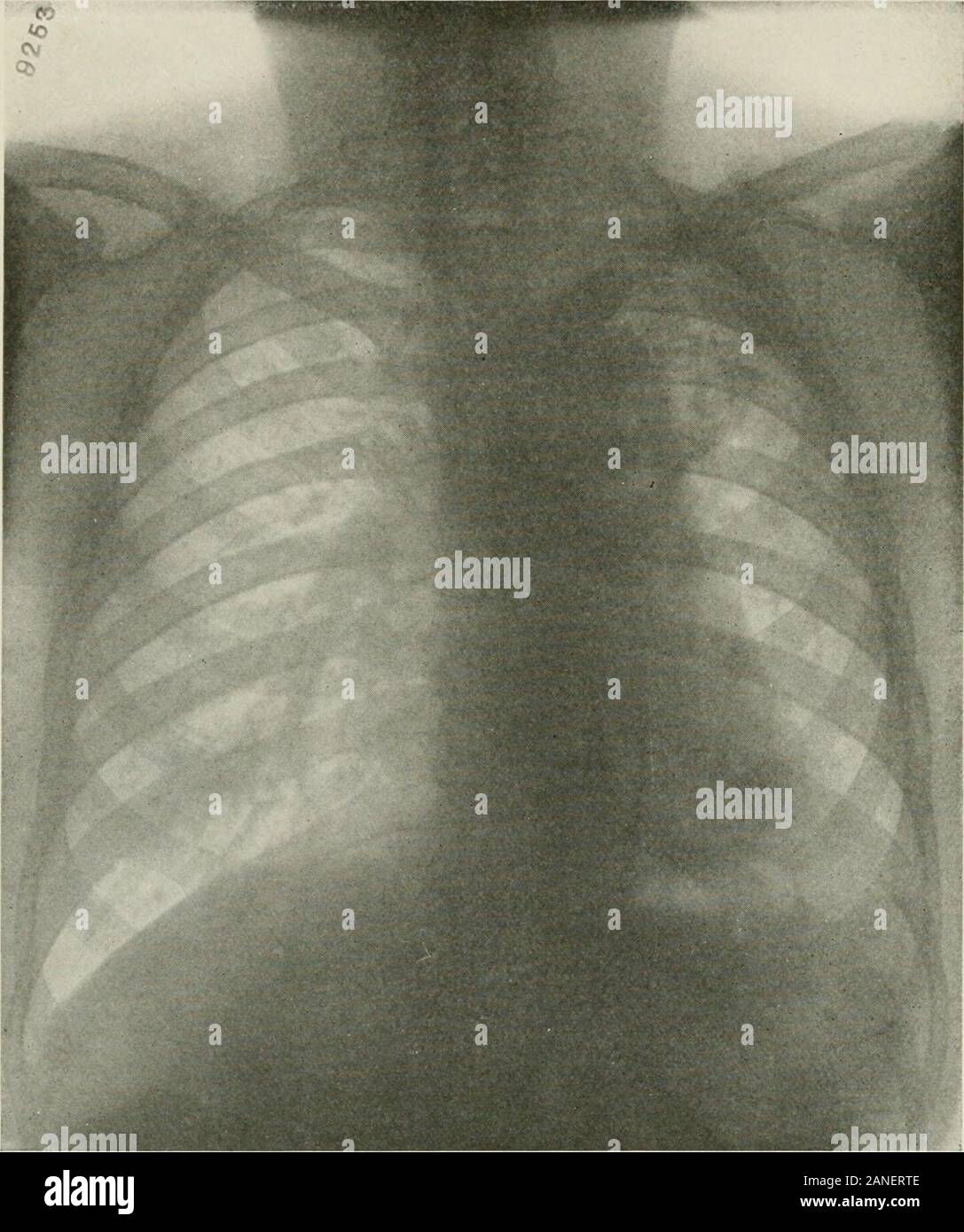 Diseases of the chest and the principles of physical diagnosis . Fig ...