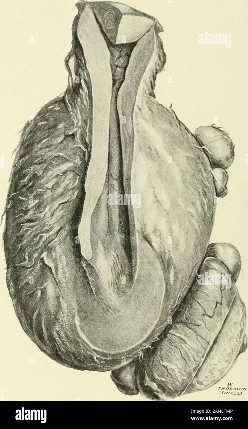 Fibroids and allied tumours (myoma and adenomyoma) : their pathology ...