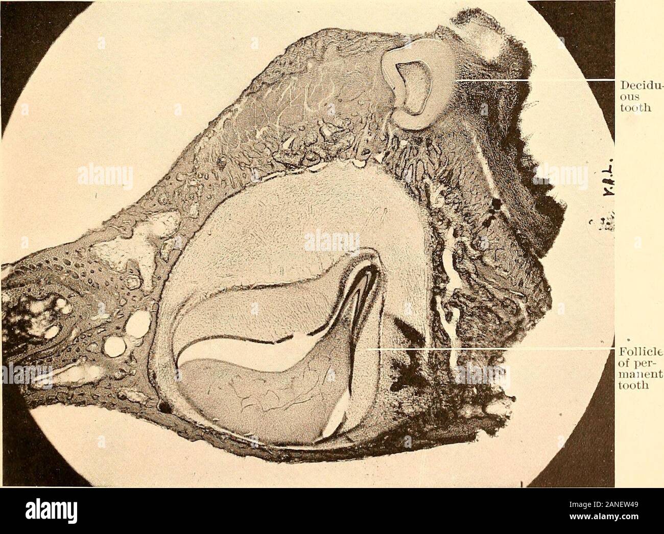 Permanent tooth eruption hi-res stock photography and images - Alamy
