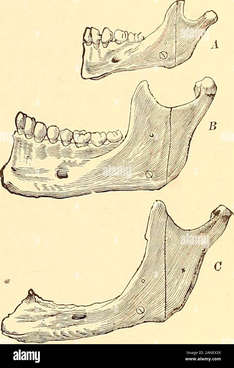 Principles and practice of operative dentistry . Inflammatoryvacuole ...