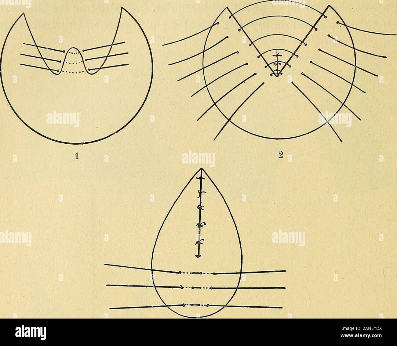 Points de suture chirurgie hi-res stock photography and images - Alamy