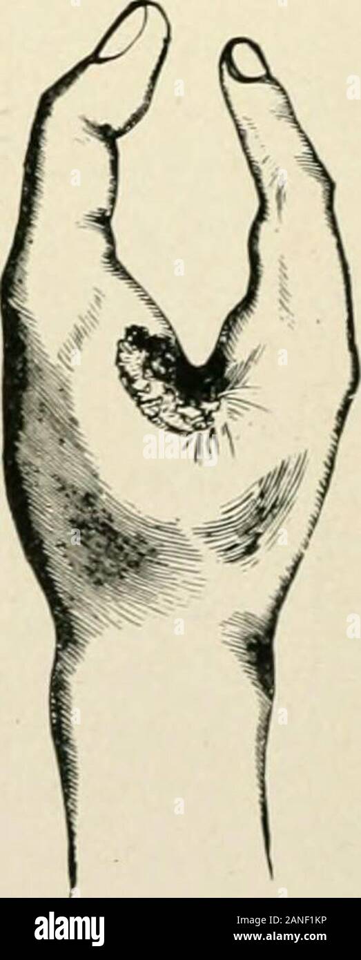 Necrosis finger hi-res stock photography and images - Alamy