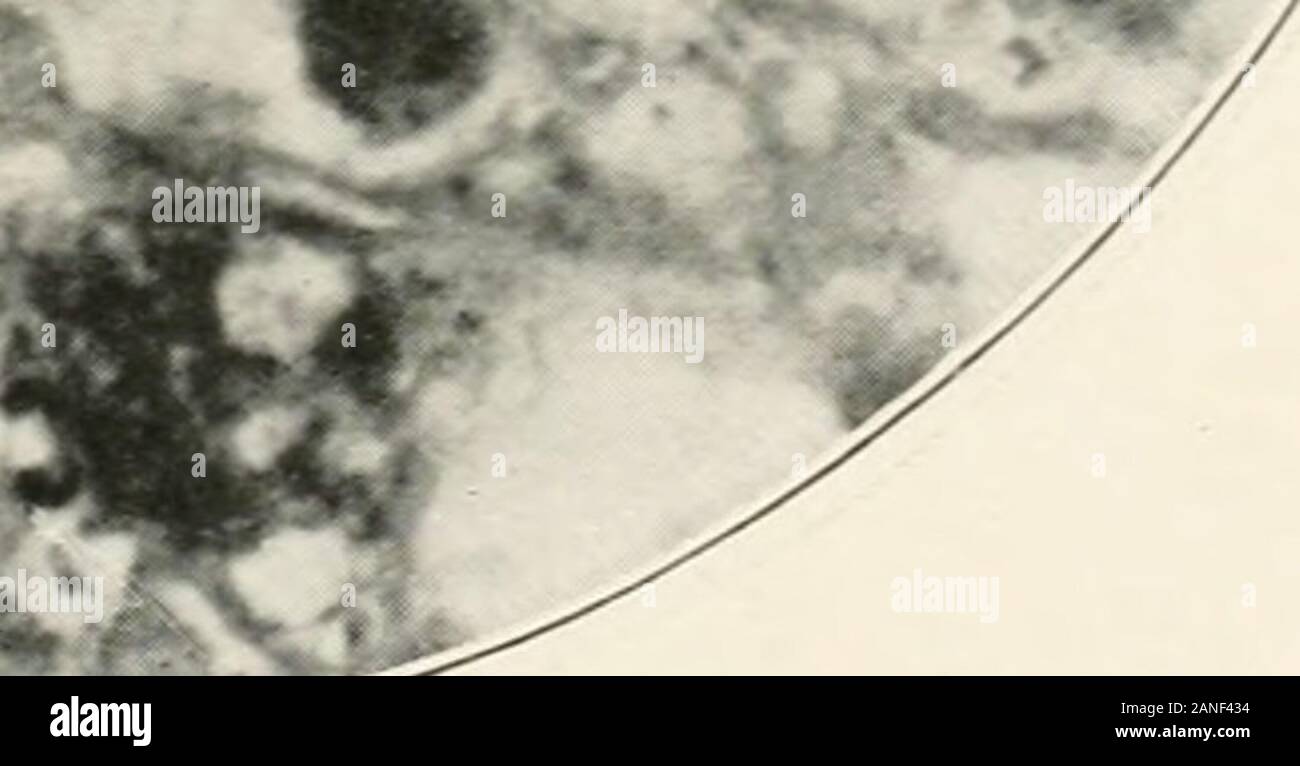 Myelin destruction hi-res stock photography and images - Alamy