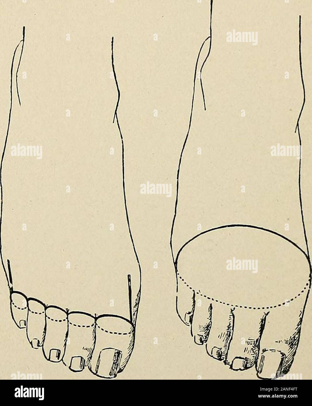 The practice of surgery . Fig. 668.—Disarticulation ofthe great toe at ...